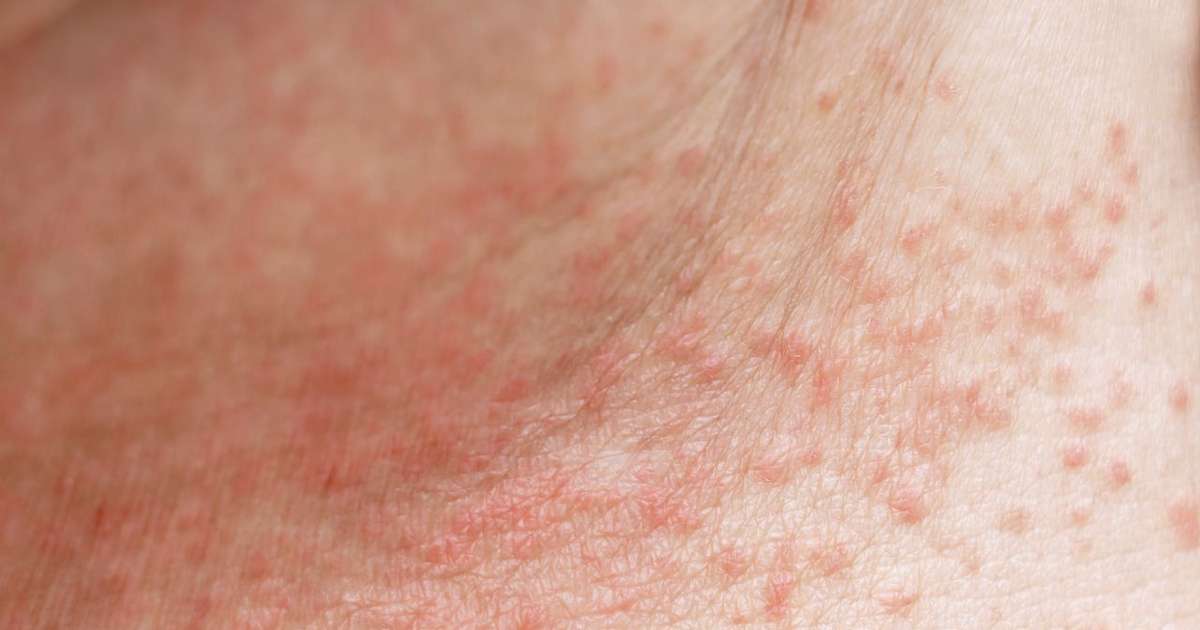 Brotoejas e assaduras: saiba como tratar e prevenir