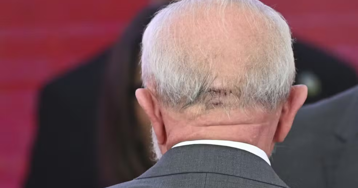 Lula tira pontos da cabeça nove dias depois de acidente