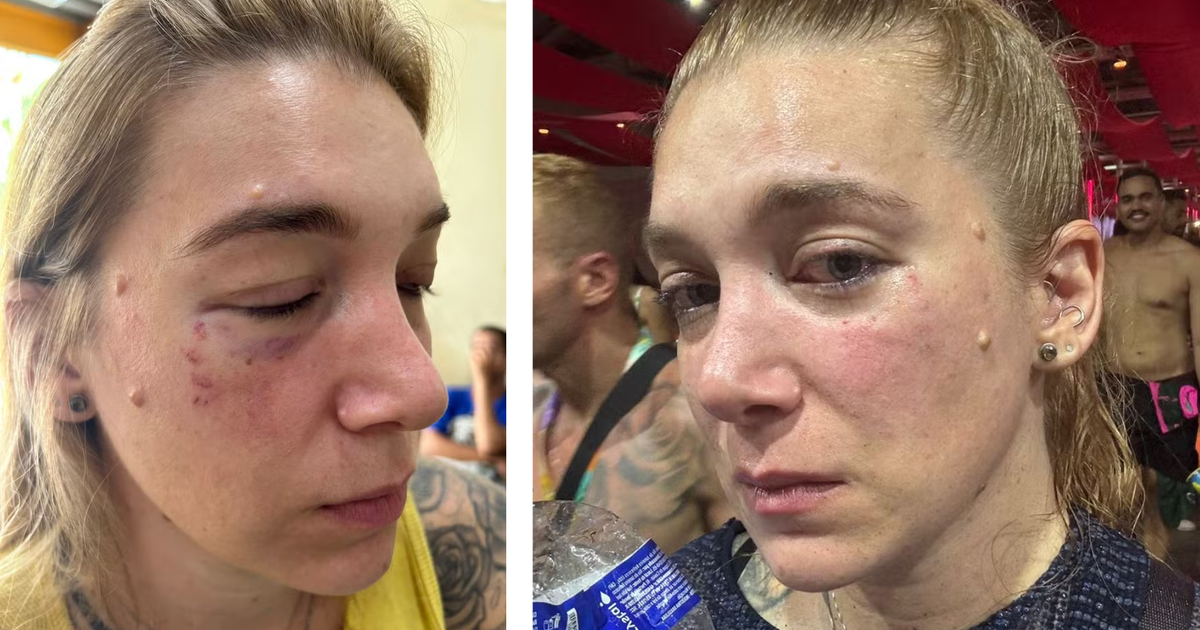 Mulher leva soco no rosto durante show da Anitta no Rio, e diz que ...