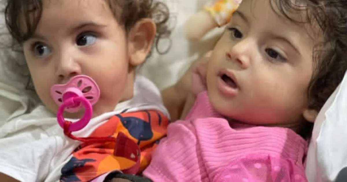 Gêmeas siamesas Kiraz e Aruna passam por cirurgia de separação em Goiânia