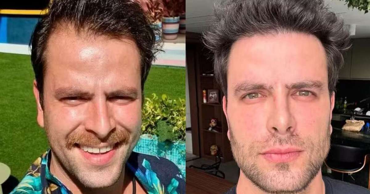 Ex-BBB Gustavo faz harmonização, transplante e perde 8kg; veja ...