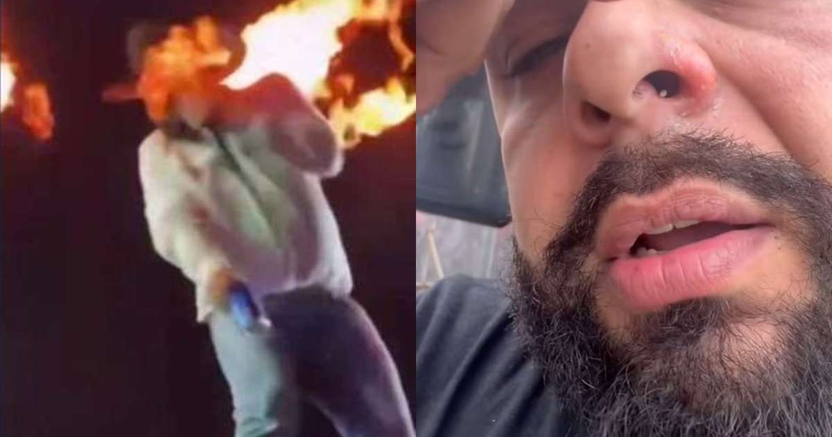 Susto! Veja como ficou o rosto queimado de cantor após pegar fogo em show