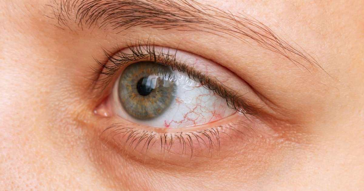 Olho seco: entenda as causas e como melhorar a condição
