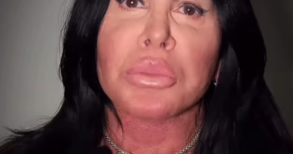 Gretchen faz nova harmonização facial e resultado surpreende; veja foto