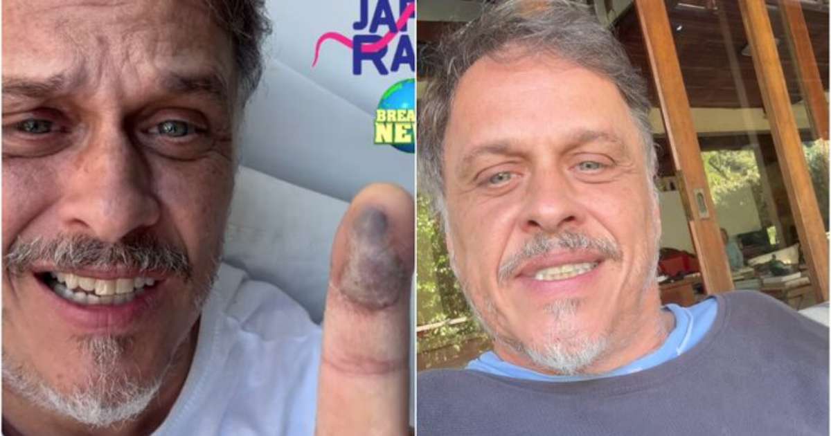 Picada de Jararaca: Guilherme Fontes Mostra Dedo Roxo e Alerta Sobre ...
