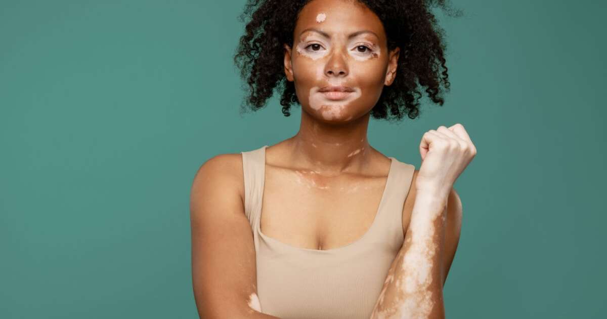 Entenda as causas e os tratamentos para o vitiligo