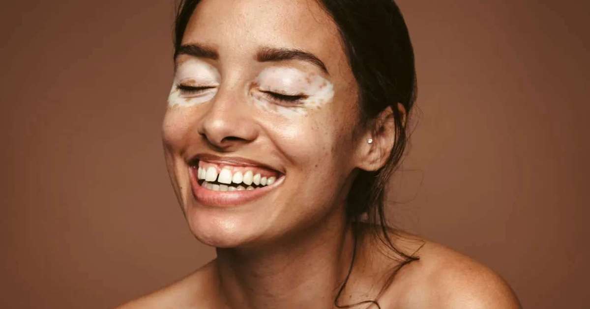 Vitiligo: entenda causas, sintomas e tratamento