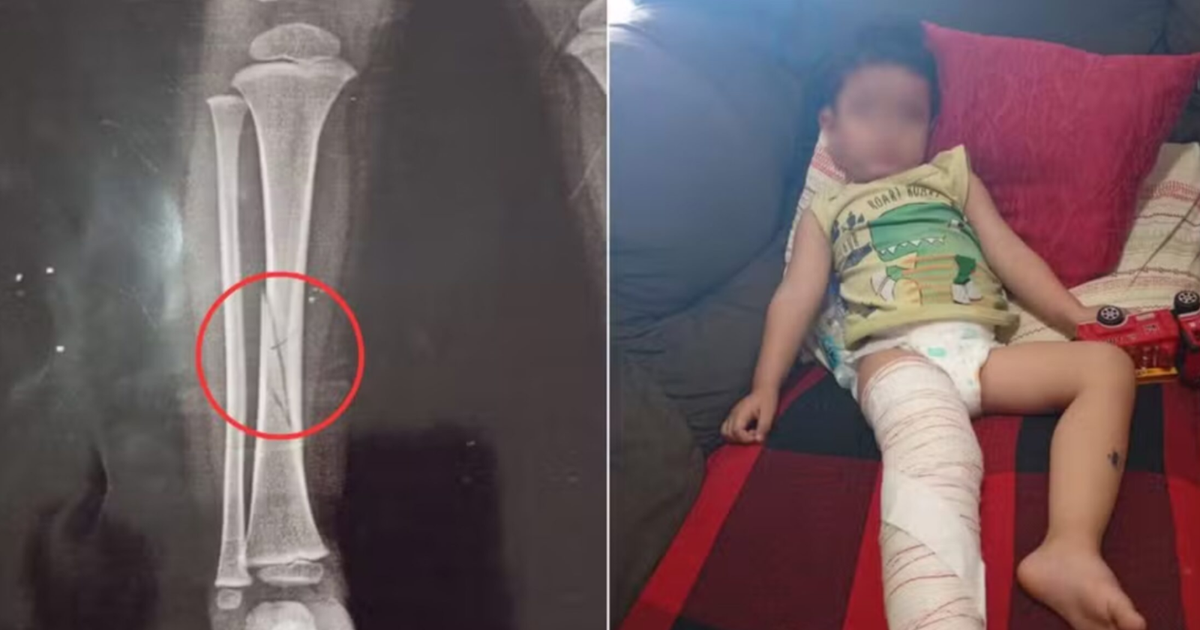 Menino de dois anos fratura a perna após briga em creche no litoral de SP