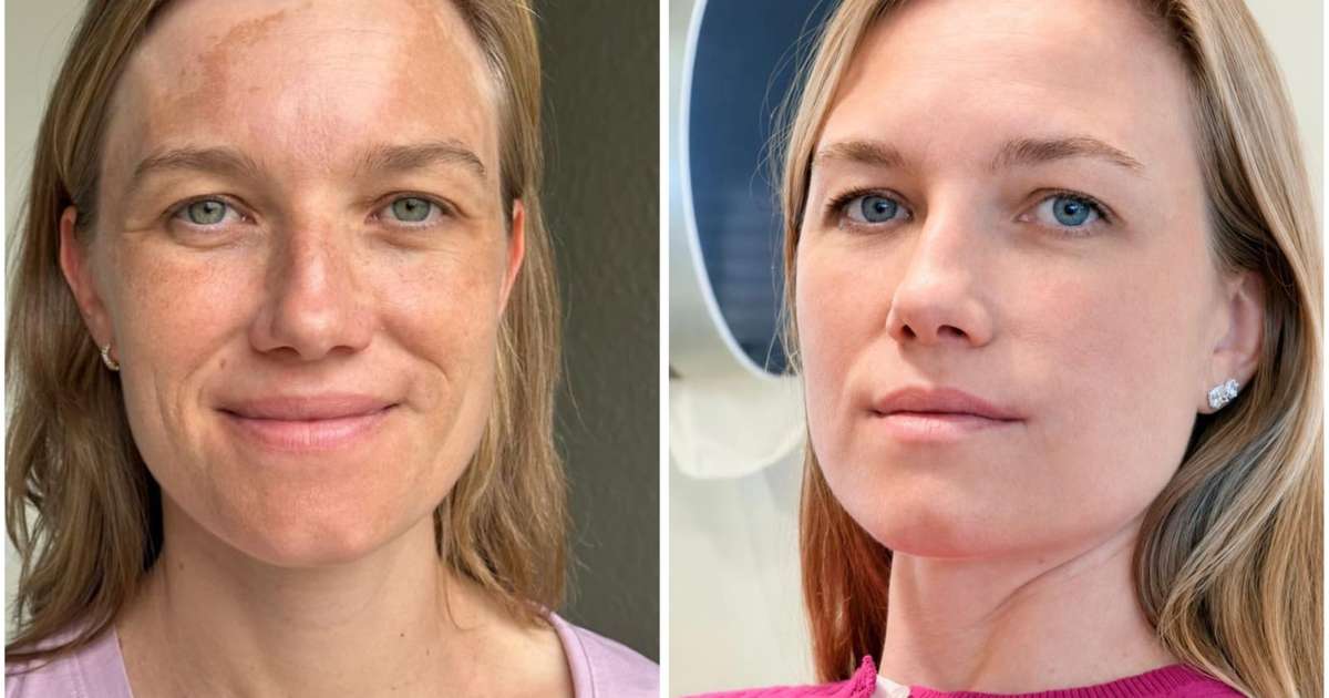 Melasma controlado: empresária surpreende com antes e depois