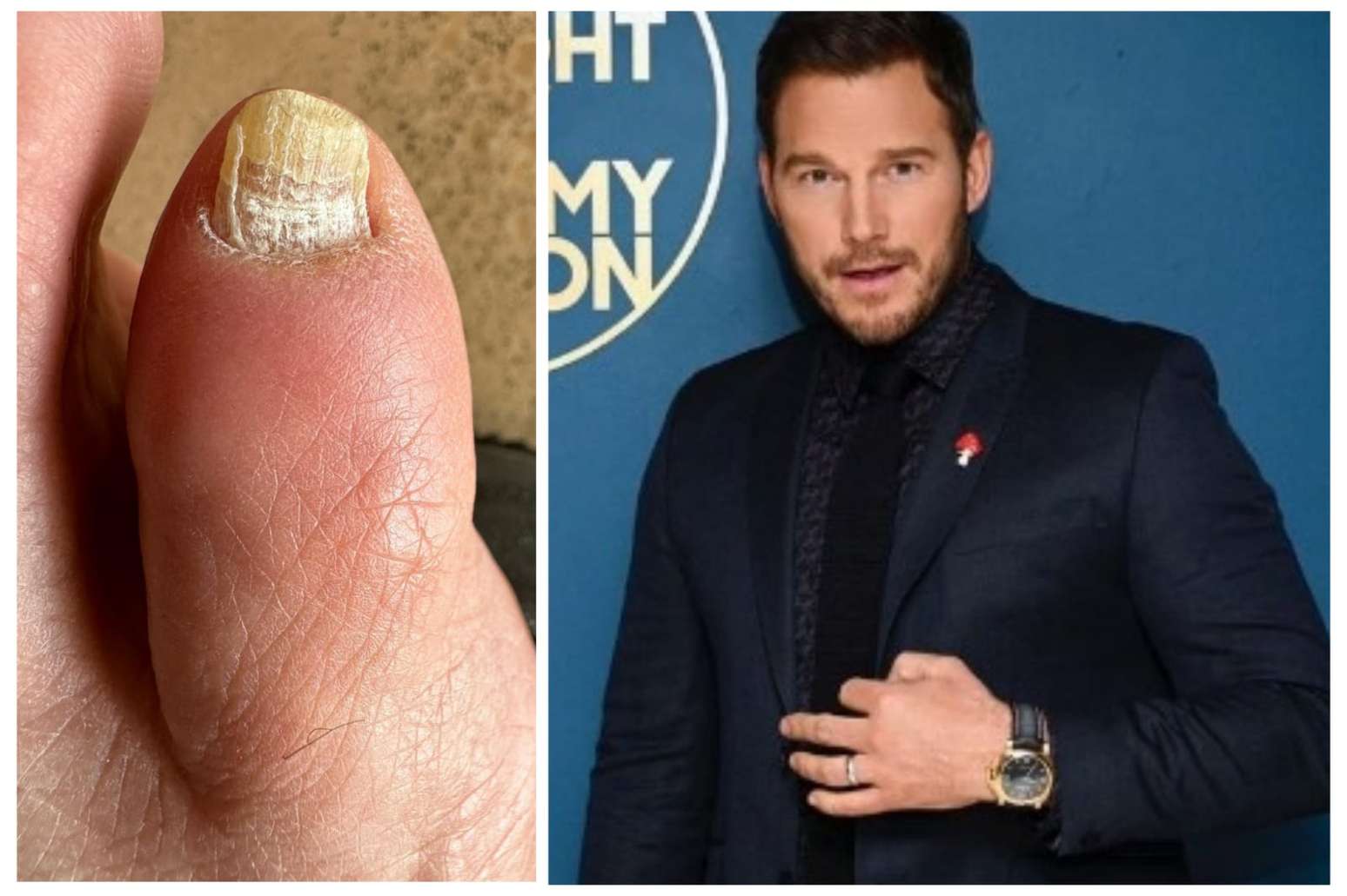 Unha amarelada de Chris Pratt pode ser sinal de infecção; saiba mais