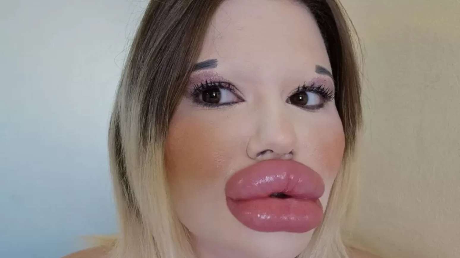 Famosa influencer dos lábios gigantes faz seis procedimentos em um dia