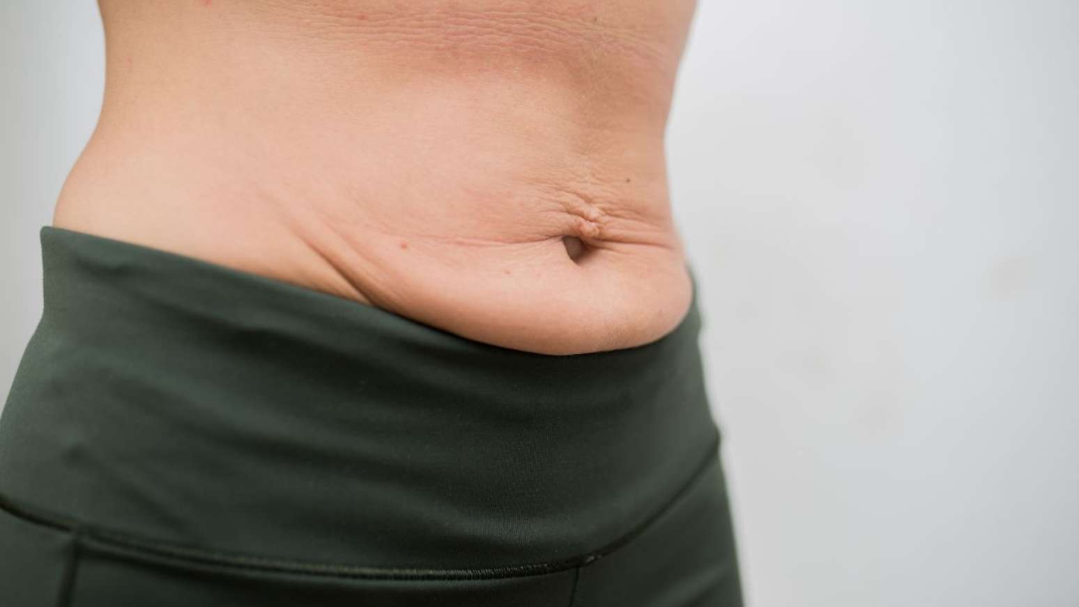 Flacidez após lipoaspiração: saiba as causas e como tratar