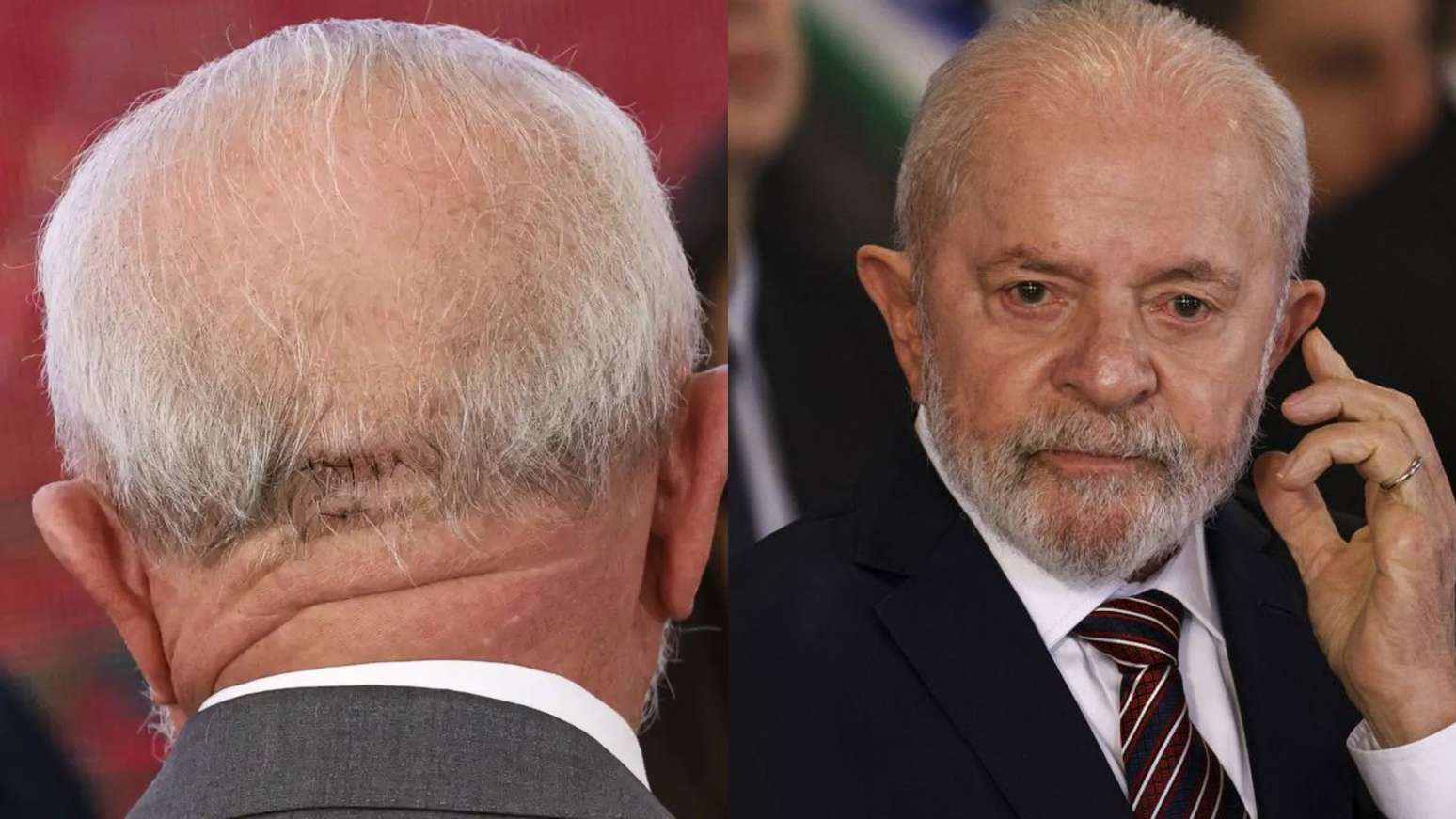 Ainda na UTI: Médicos atualizam sobre estado de saúde de Lula após ...