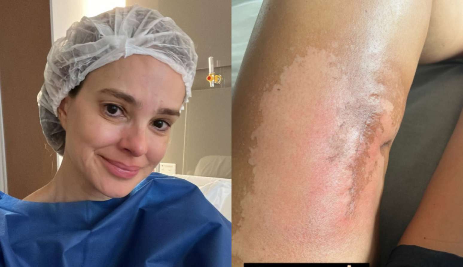 Vera Viel mostra cicatriz na perna após retirada de tumor raro: 'Processo'