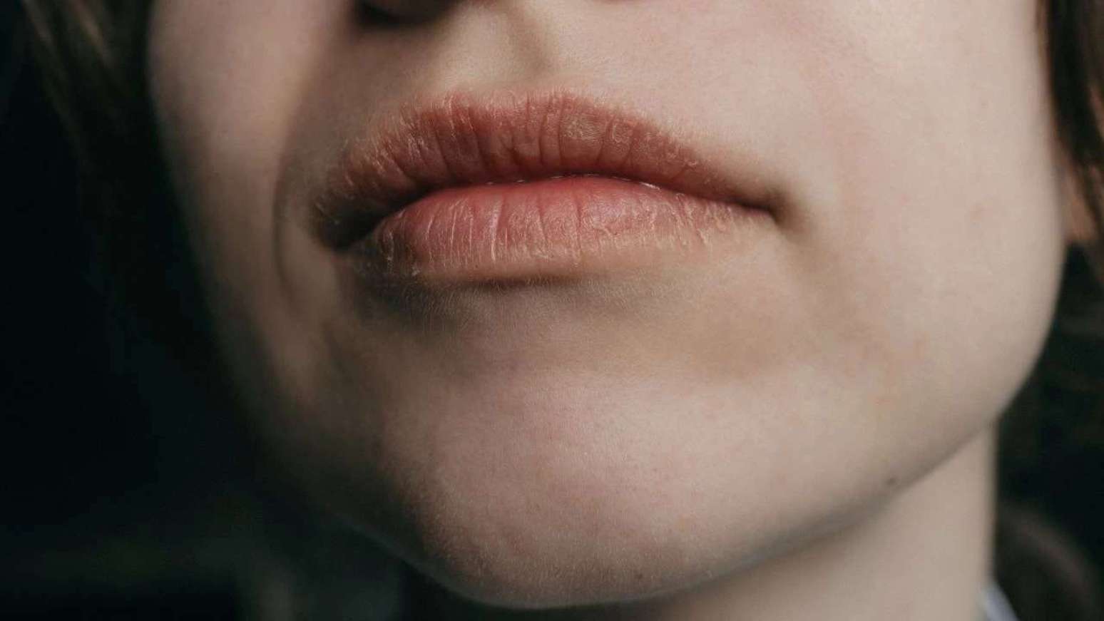 Lábios ressecados no verão? Veja como mantê-los saudáveis