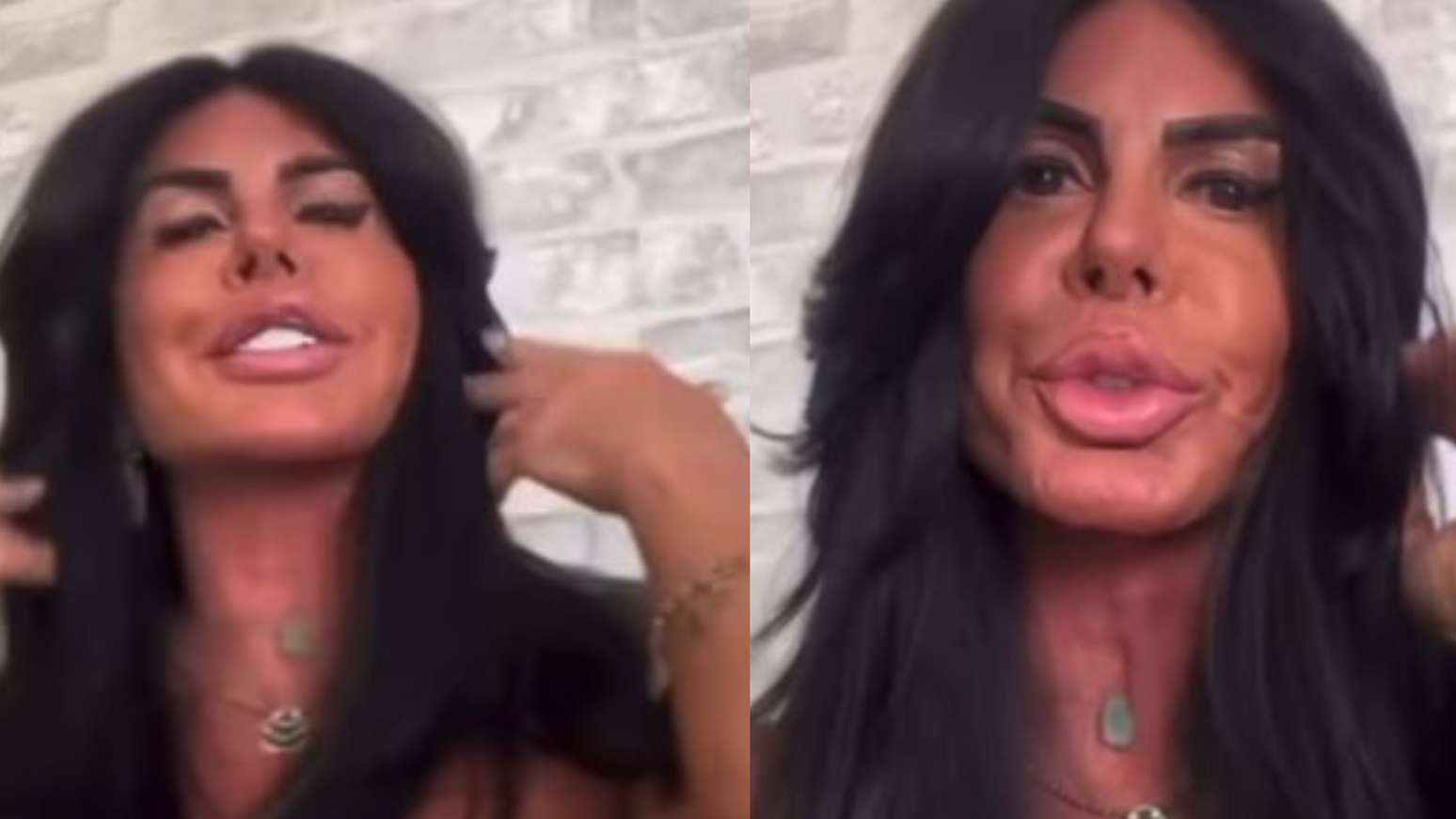 Gretchen faz novo procedimento no rosto e surpreende com o resultado: 'Fininho'