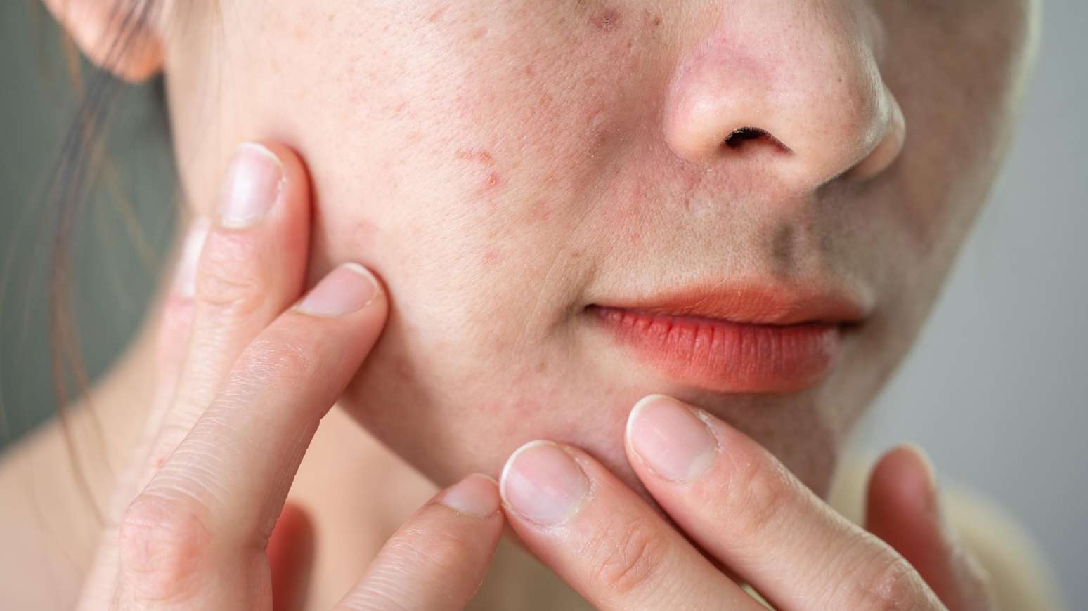 Roacutan: Descubra os Riscos e Benefícios do Tratamento Contra Acne