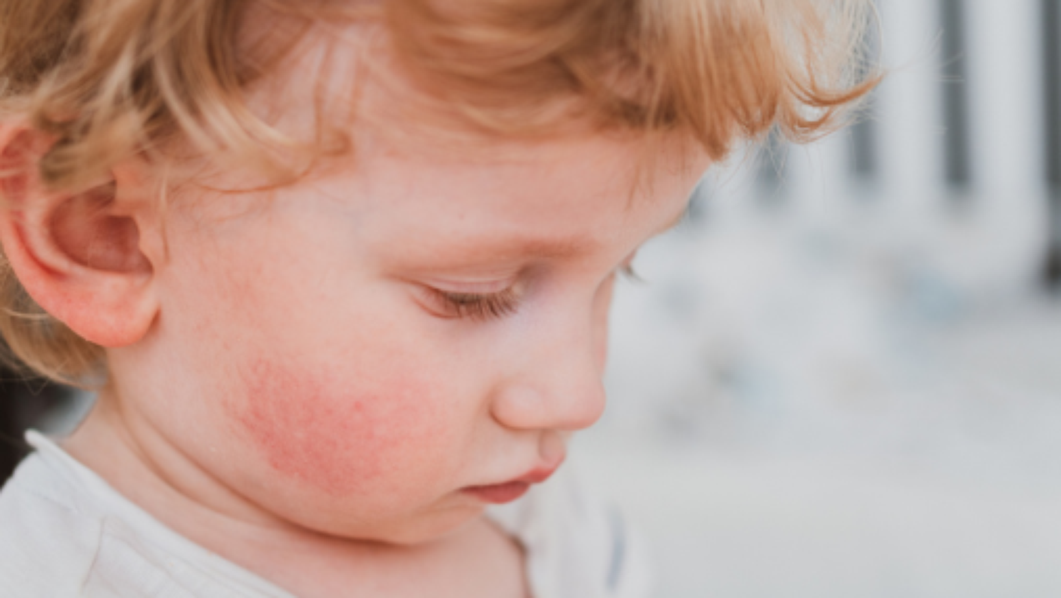 Eritema Infeccioso: Sintomas, Contágio e Prevenção em Crianças