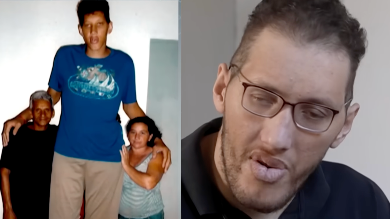 Homem mais alto do Brasil fala sobre risco de amputar a segunda perna; veja