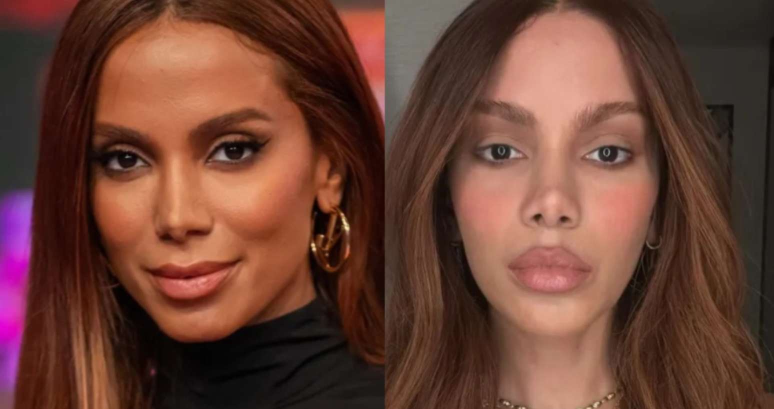 Médico explica em detalhes a cirurgia plástica que mudou o rosto de Anitta