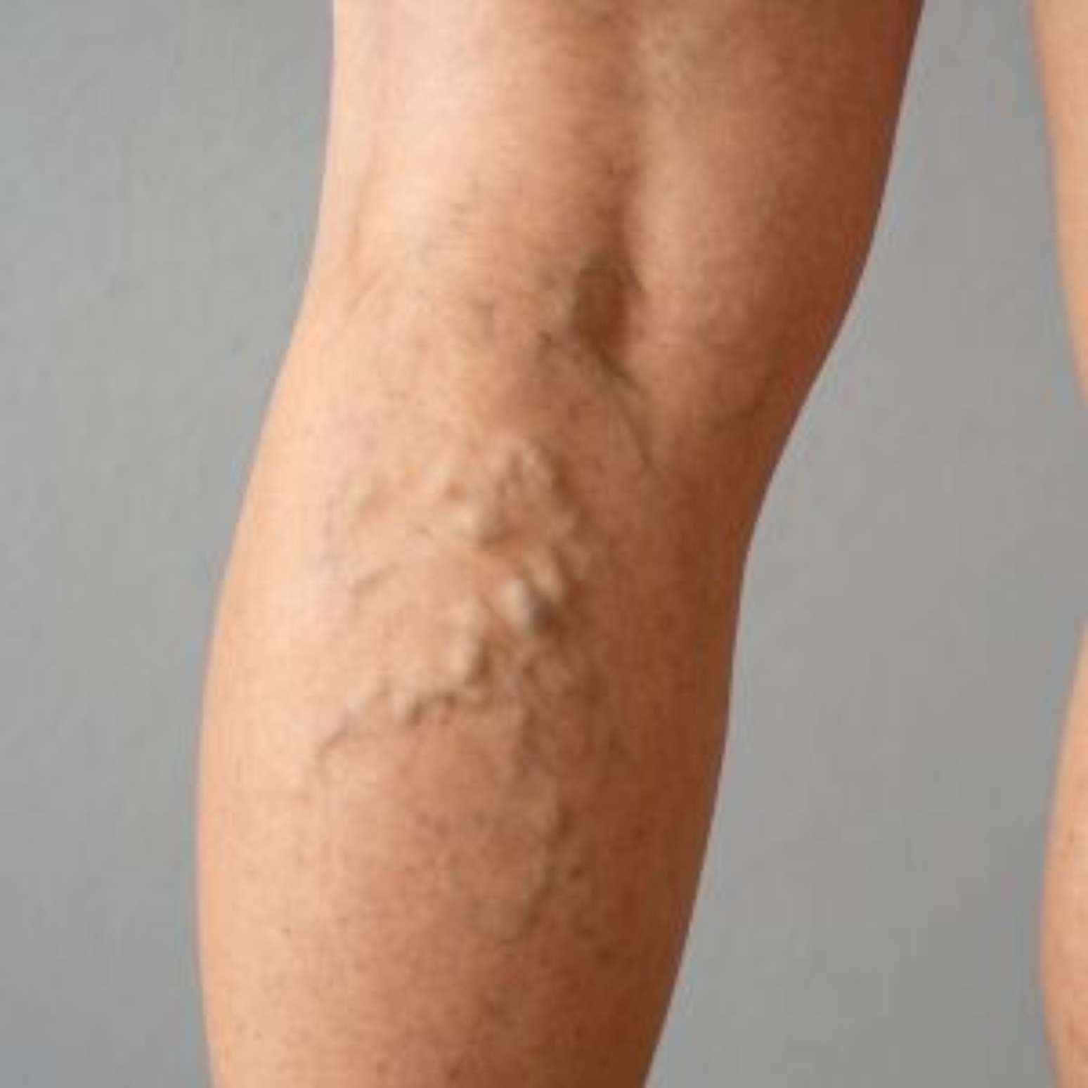 Varizes: entenda os riscos da doença e como prevenir o avanço silencioso