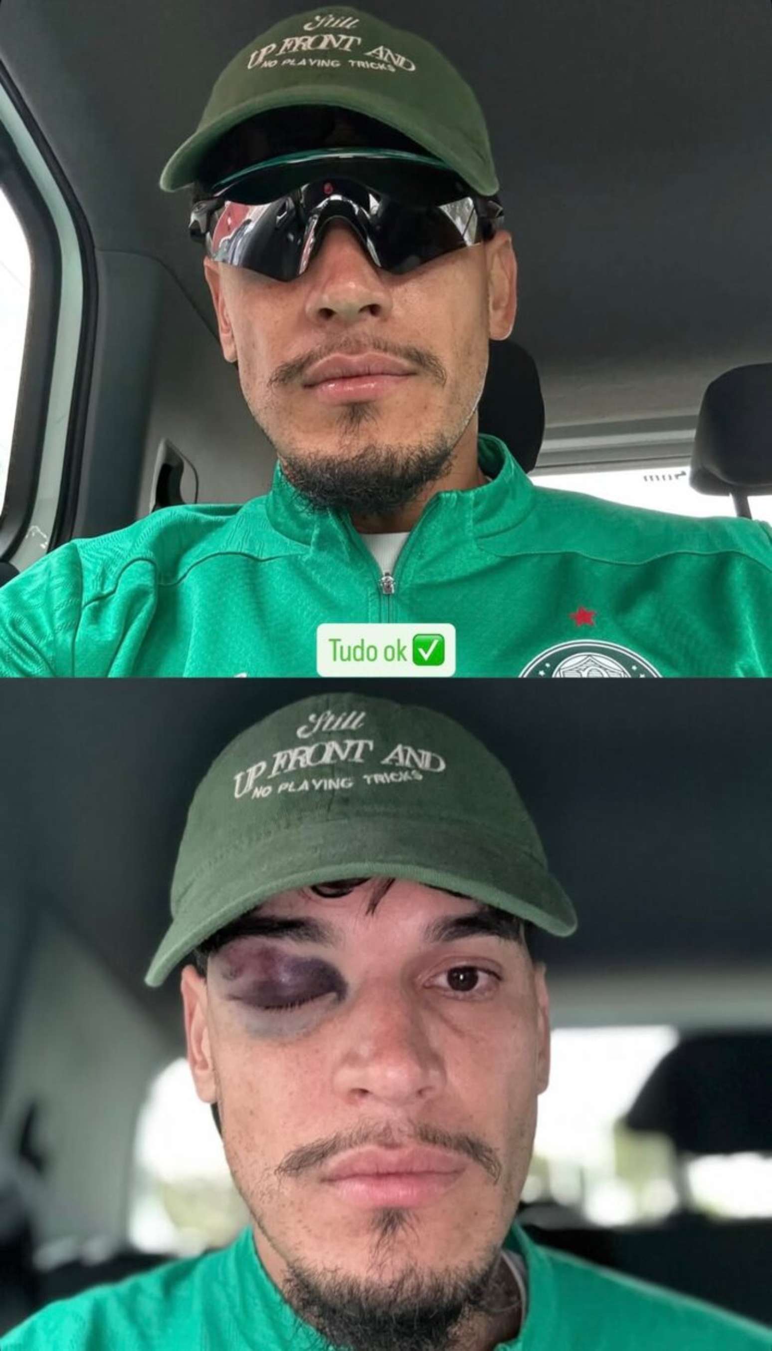 Gustavo Gómez posta foto com olho roxo após jogo com o River Plate ...