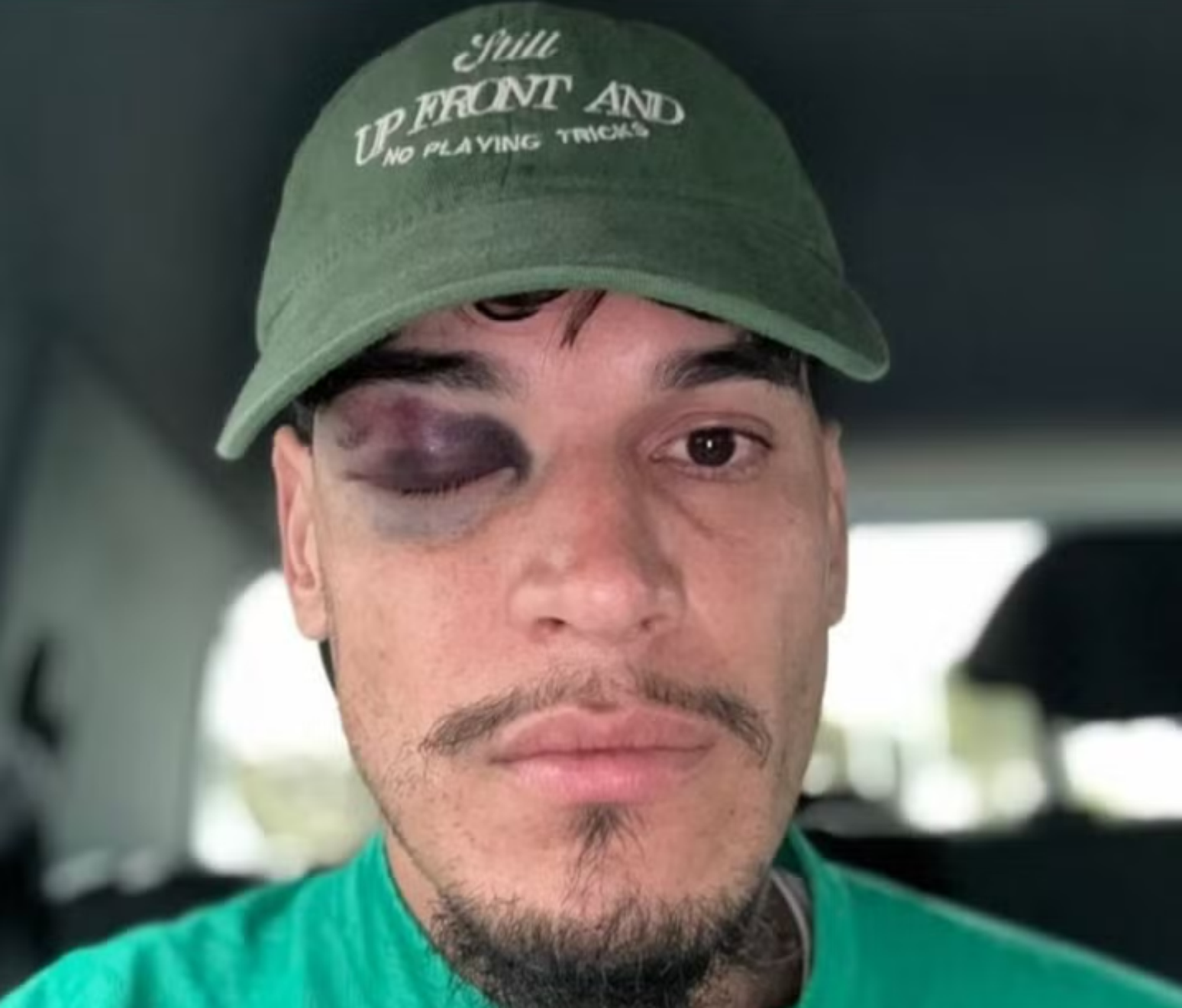 Gustavo Gómez mostra olho roxo após pancada em classificação do Palmeiras