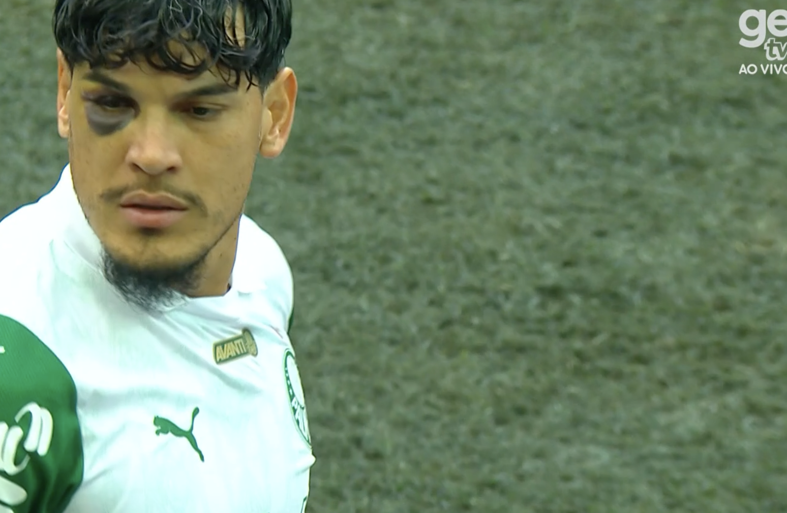 Olho roxo de Gustavo Gómez chama a atenção; veja a imagem