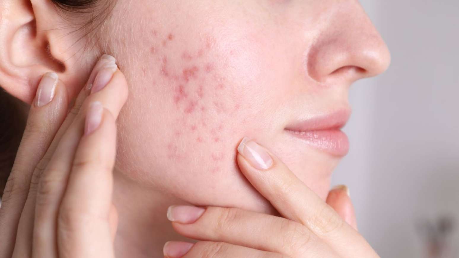 Acne adulta: por que acontece e como cuidar da pele sem exageros