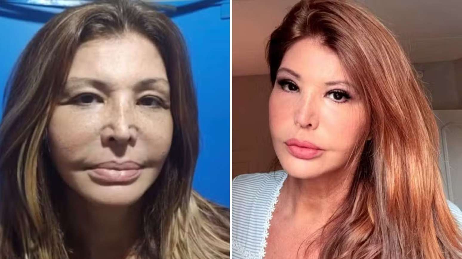 Roberta Close faz cirurgia plástica aos 60 anos e médica alerta ...