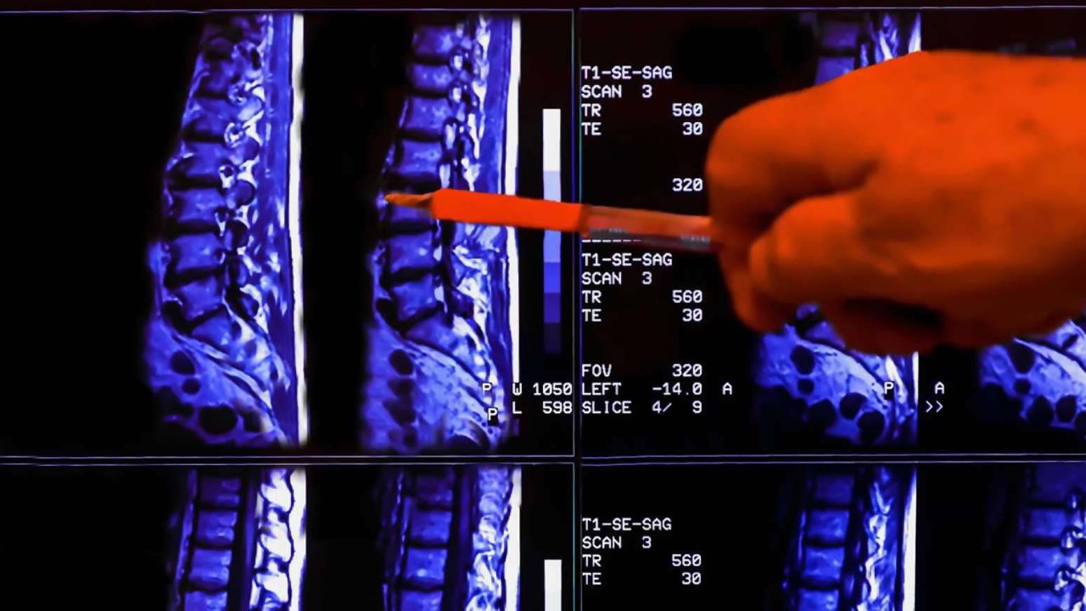 Mielite transversa: entenda a doença que afeta a medula espinhal