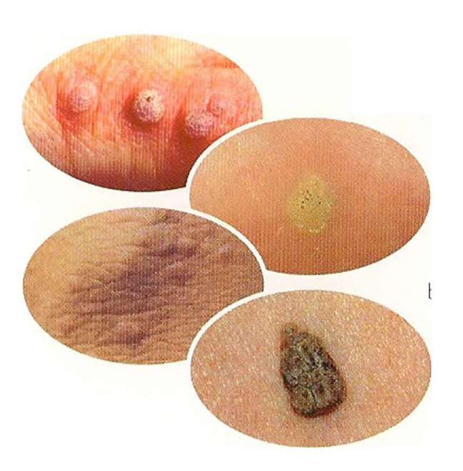 Verrugas: conheça os tipos, causas e tratamentos, e saiba o que fazer ...