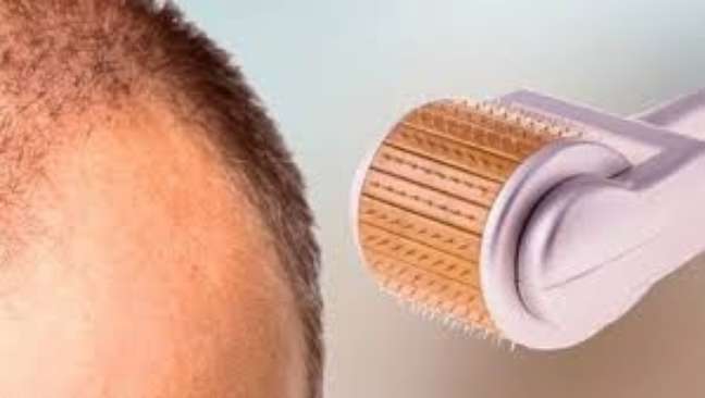 Microagulhamento capilar pode ajudar na queda de cabelo
