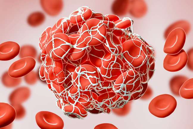 Trombose: conheça 5 hábitos que favorecem e previnem a doença