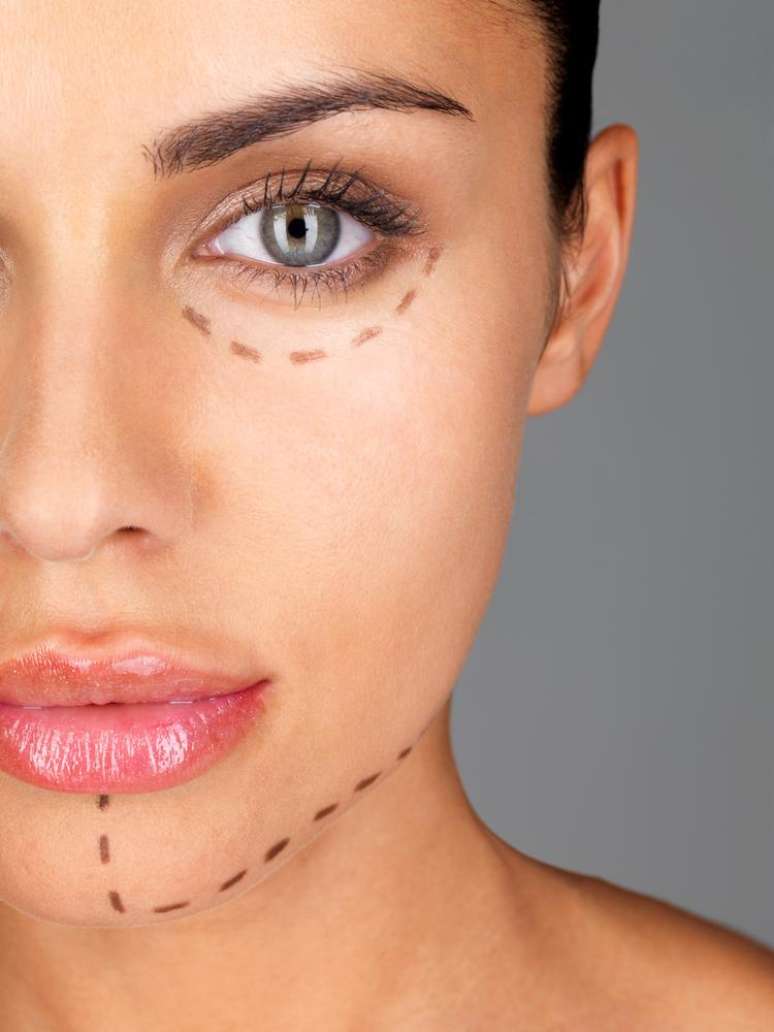 Minilifting com plasma do sangue rejuvenesce a face