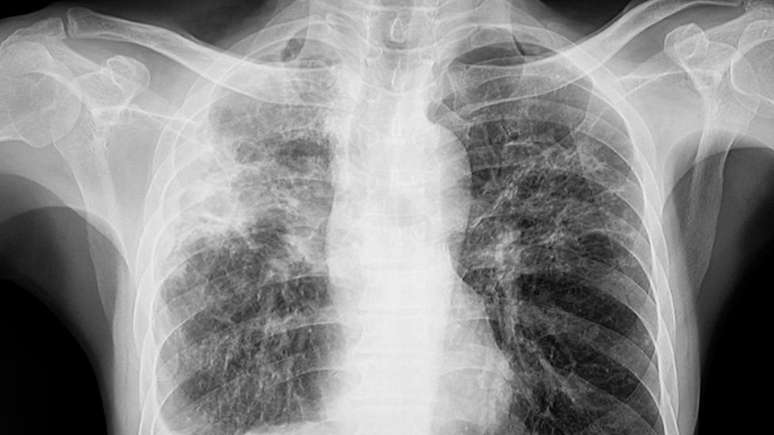Tuberculose pulmonar ultrapassa fronteiras de presídios e favelas no Brasil