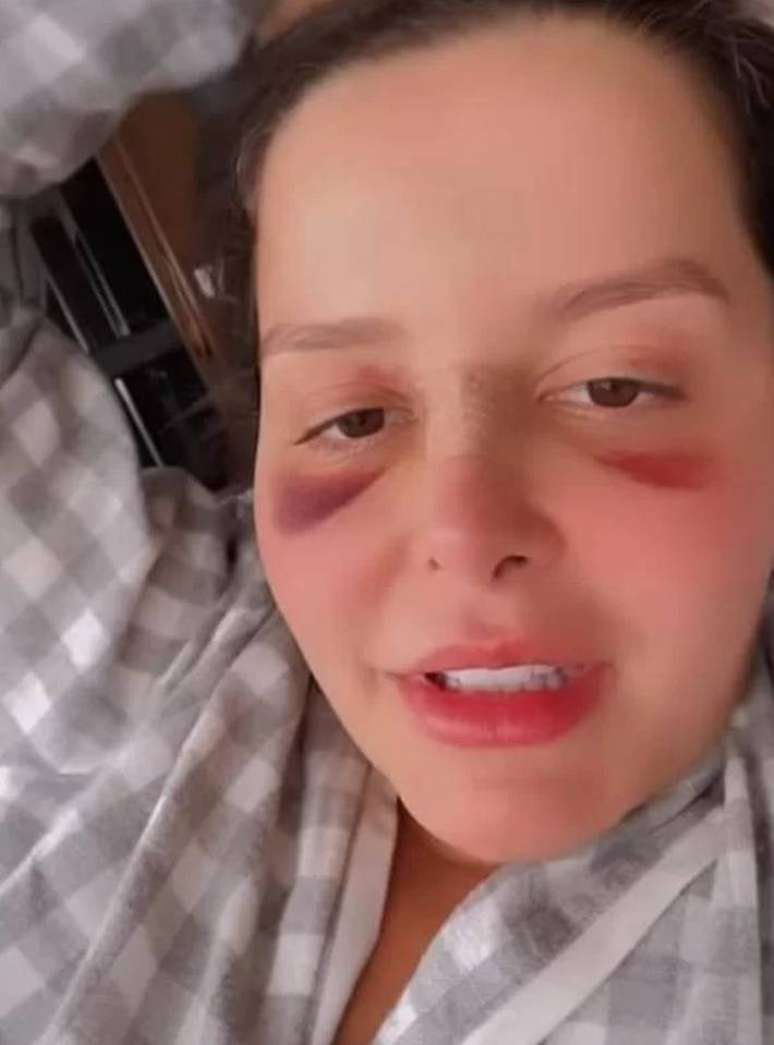 Maraísa mostra como está seu rosto após acidente em banheira; veja Maraísa mostra como está seu rosto após acidente em banheira; veja