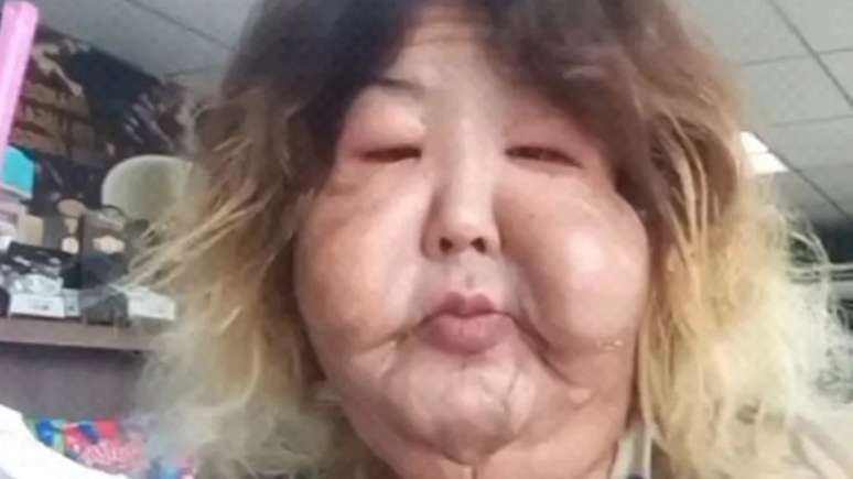 Entenda a cirurgia que Juju Pix passou para reconstrução do rosto