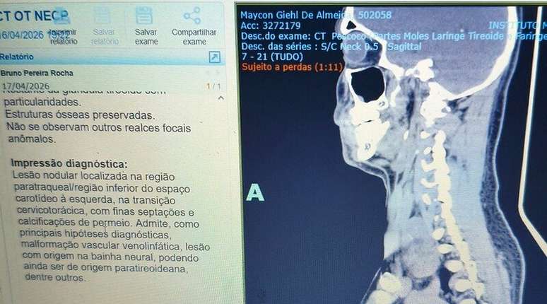 Cirurgia remoção de tumor no pescoço: a corrida contra o tempo