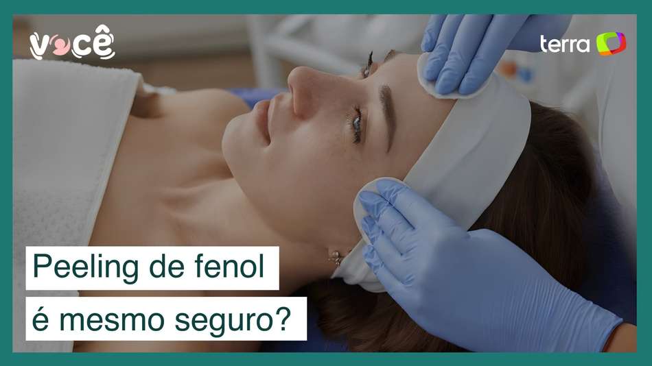Peeling de fenol é mesmo seguro? Veja como evitar complicações